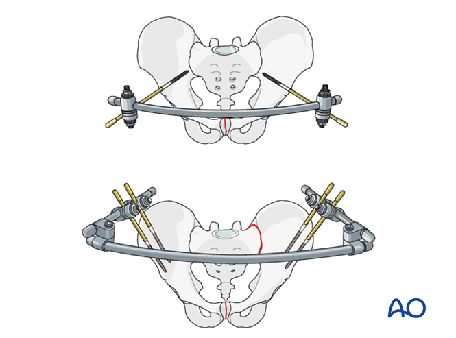 Operative treatment for Incomplete disruption of posterior arch ...