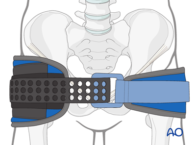 Operative treatment for Incomplete disruption of posterior arch, open ...