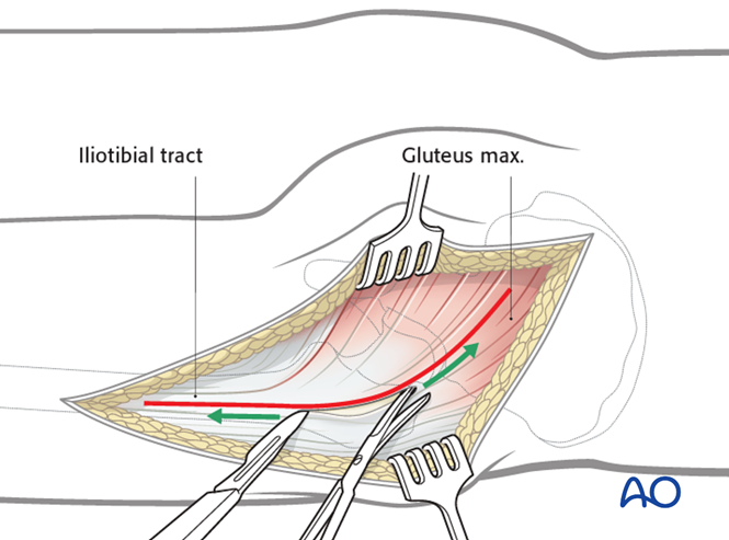 Kocher-Langenbeck approach to the acetabulum