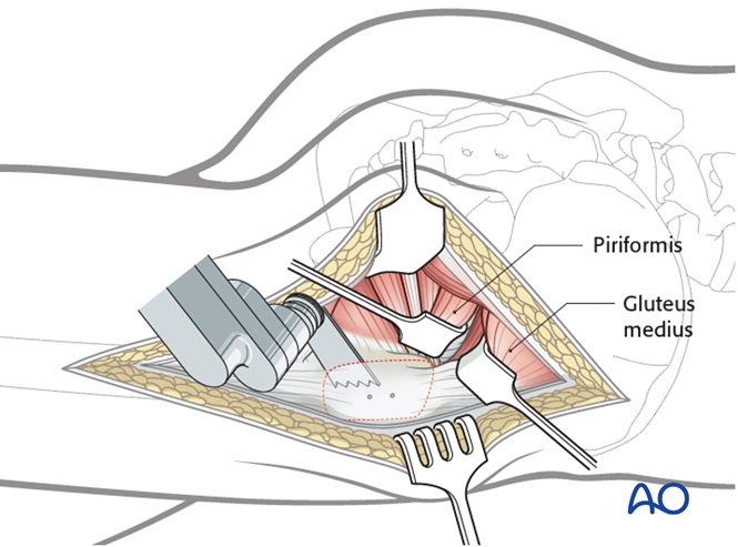 Kocher-Langenbeck approach to the acetabulum