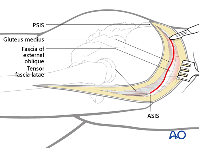 Extended iliofemoral approach to the acetabulum