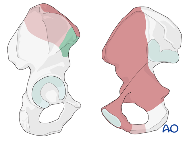 Ilioinguinal approach to the acetabulum
