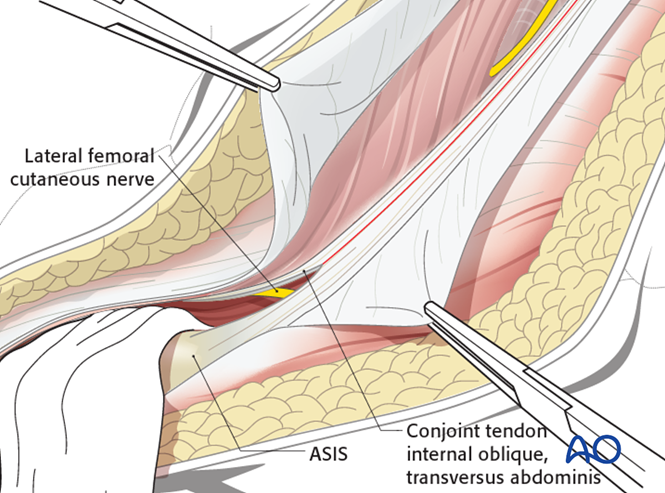 Ilioinguinal approach to the acetabulum