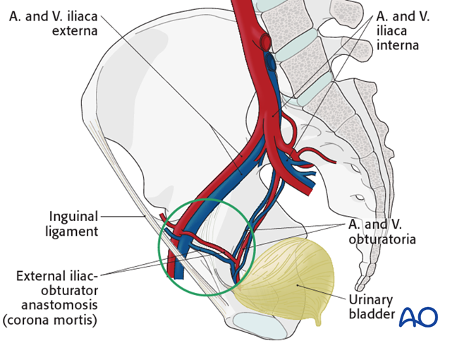 Ilioinguinal approach to the acetabulum