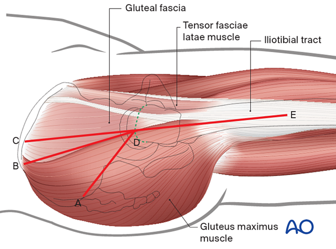 Trochanter osteotomy of the acetabulum