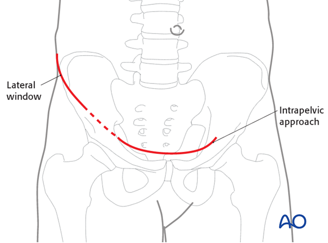Modified Stoppa approach to the acetabulum