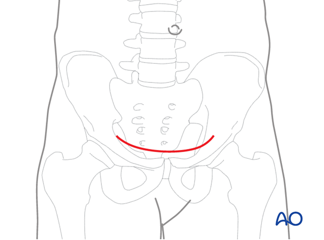 Modified Stoppa approach to the acetabulum