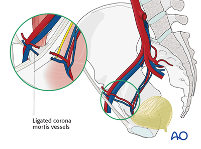 Modified Stoppa approach to the acetabulum