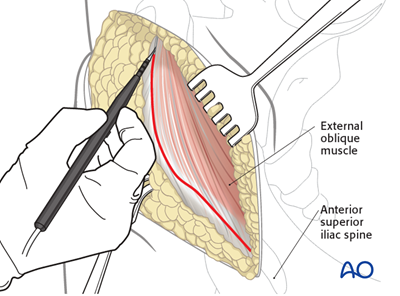 Modified Stoppa approach to the acetabulum
