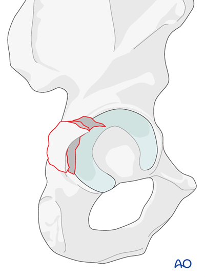 Posterior wall