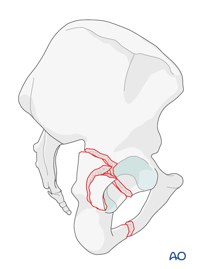 Posterior column and wall