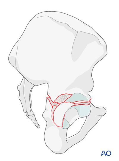 Transverse and posterior wall