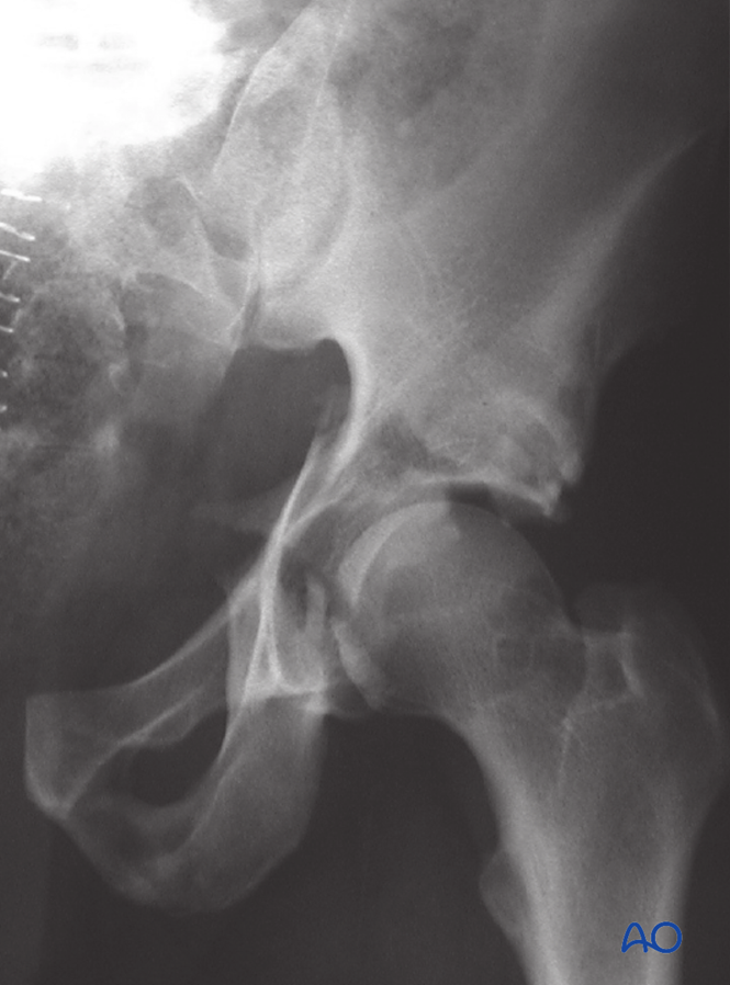 Transverse and posterior wall