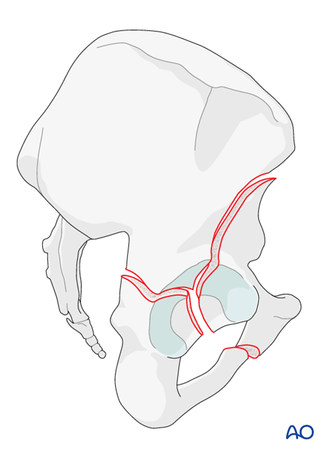 Anterior column and posterior hemitransverse