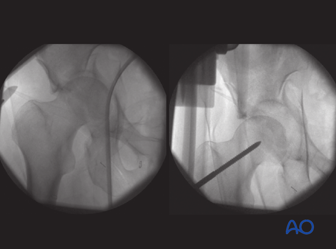 ORIF through modified Stoppa approach for Anterior column and posterior ...
