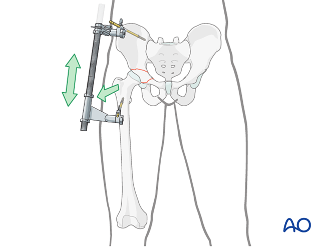 ORIF through ilioinguinal approach for Anterior wall
