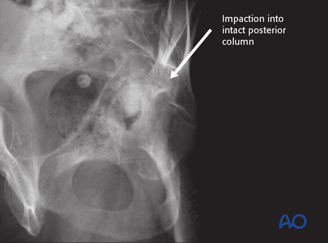 ORIF through modified Stoppa approach for Anterior column