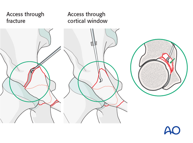 ORIF through modified Stoppa approach for Anterior column