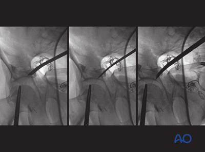 ORIF through modified Stoppa approach for Anterior column