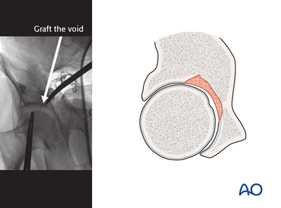 ORIF through modified Stoppa approach for Anterior column