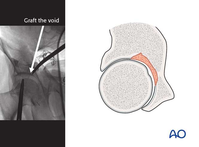 ORIF through ilioinguinal approach for Anterior column and posterior ...