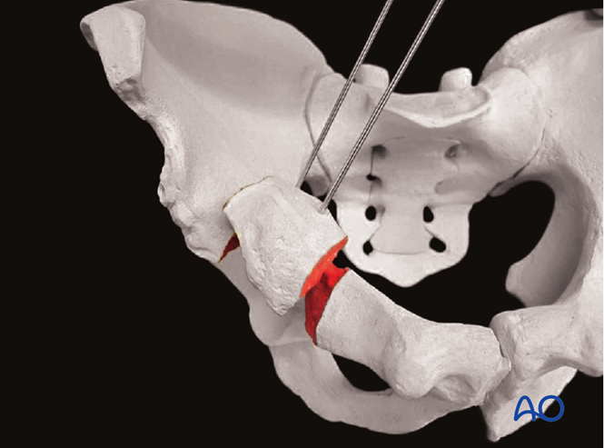 ORIF through ilioinguinal approach for Anterior wall