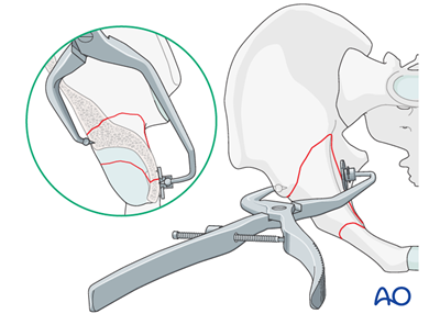 ORIF through ilioinguinal approach for Anterior wall