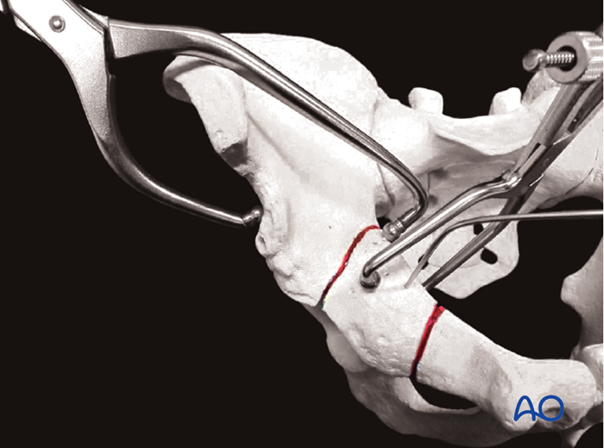ORIF through ilioinguinal approach for Anterior wall