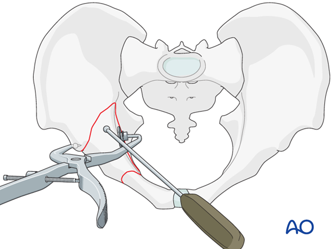 ORIF through ilioinguinal approach for Anterior wall