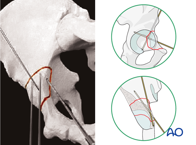 ORIF through ilioinguinal approach for Anterior wall