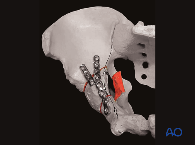 ORIF through ilioinguinal approach for Anterior wall