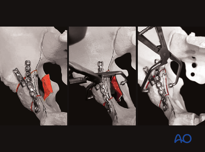 ORIF through ilioinguinal approach for Anterior wall