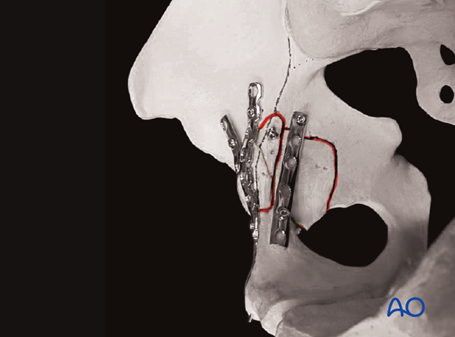 ORIF through ilioinguinal approach for Anterior wall