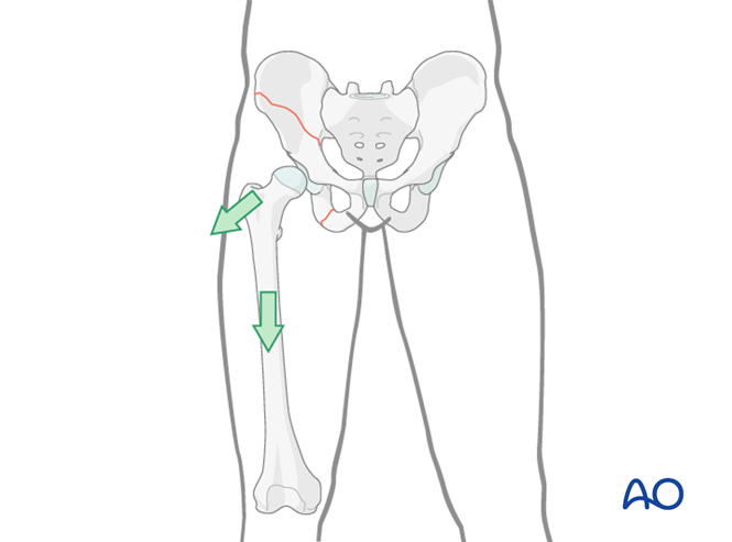 ORIF through ilioinguinal approach for Anterior column