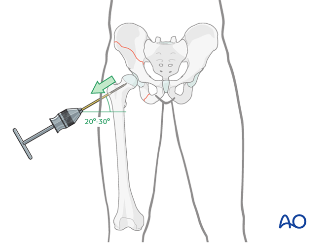 ORIF through ilioinguinal approach for Anterior column