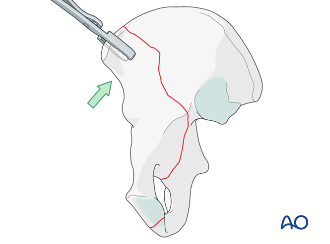 ORIF through ilioinguinal approach for Anterior column