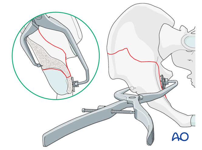 ORIF through ilioinguinal approach for Anterior column