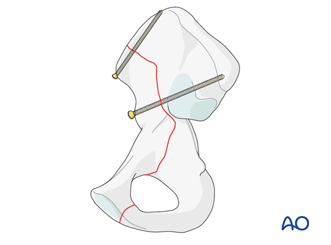 ORIF through ilioinguinal approach for Anterior column