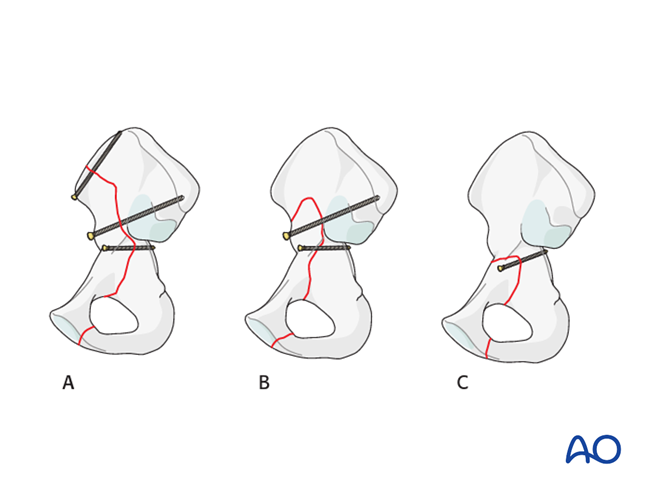 ORIF through ilioinguinal approach for Anterior column