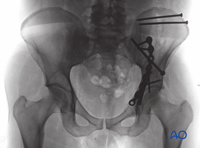 ORIF through modified Stoppa approach for Anterior column