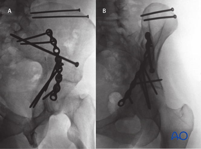 ORIF through modified Stoppa approach for Anterior column