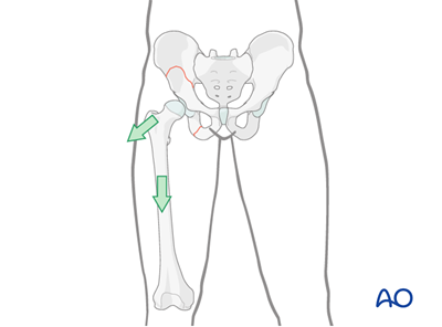 ORIF through modified Stoppa approach for Anterior column