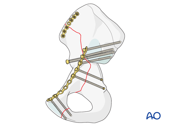 ORIF through modified Stoppa approach for Anterior column