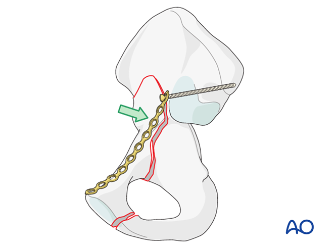 ORIF through modified Stoppa approach for Anterior column