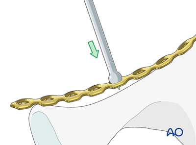 ORIF through modified Stoppa approach for Anterior column