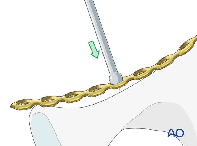ORIF through modified Stoppa approach for T-type