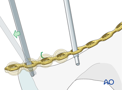 ORIF through modified Stoppa approach for Transverse
