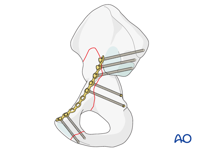 ORIF through modified Stoppa approach for Anterior column