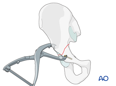 ORIF through extended iliofemoral approach for Transverse