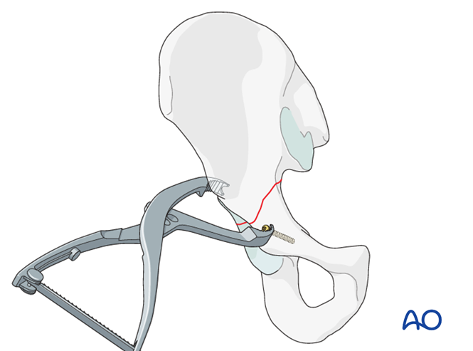 ORIF through extended iliofemoral approach for Transverse